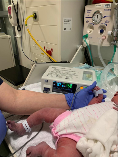 New pulse oximeters for Trust birthing units – SaTH